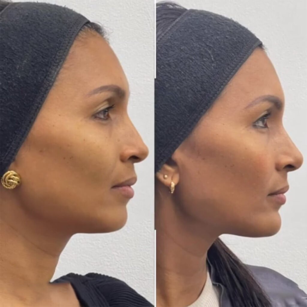 Perfilamiento facial sin cirugía - HB Medical Center